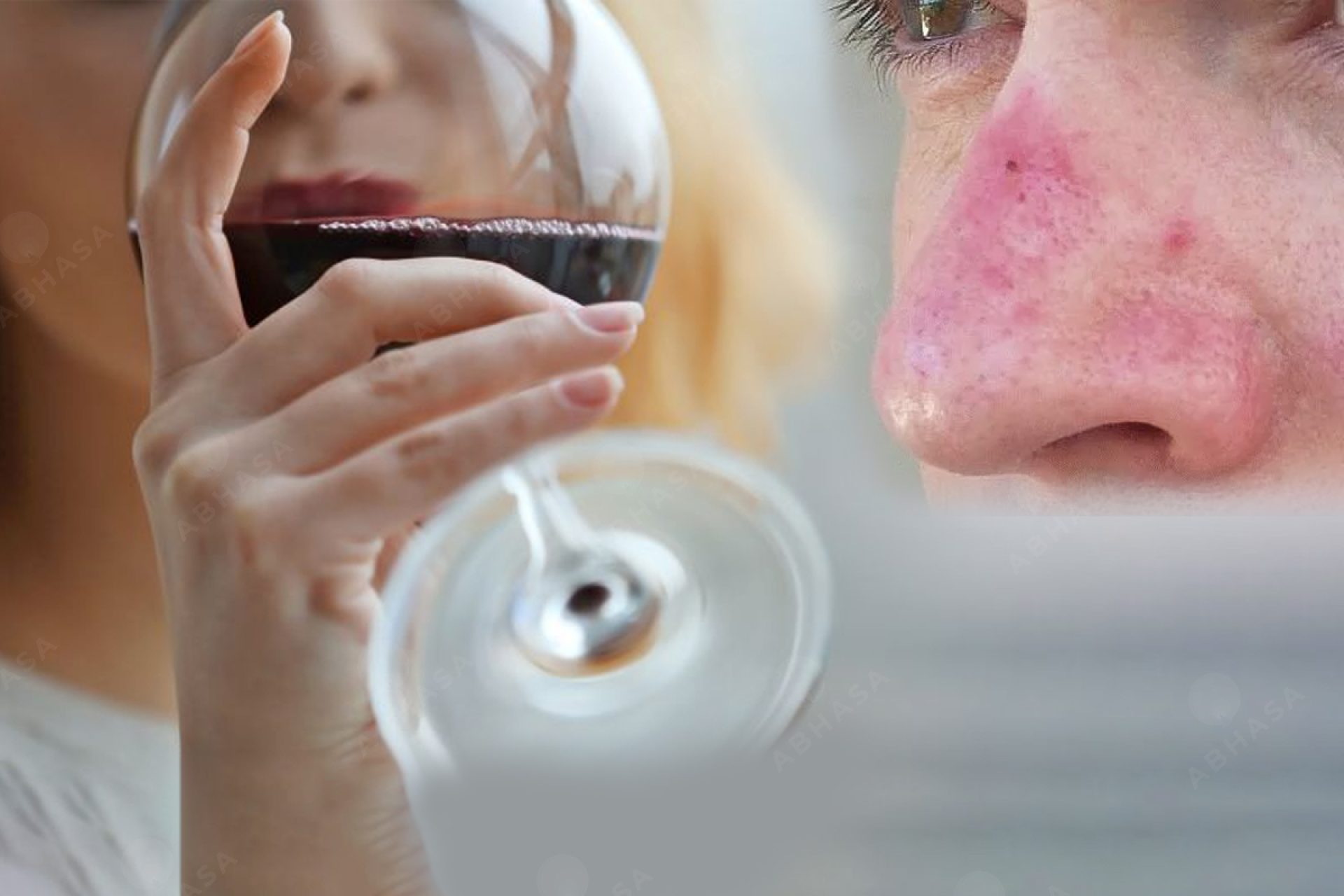 Alcoholic Nose: The Impact of Alcohol on Your Body